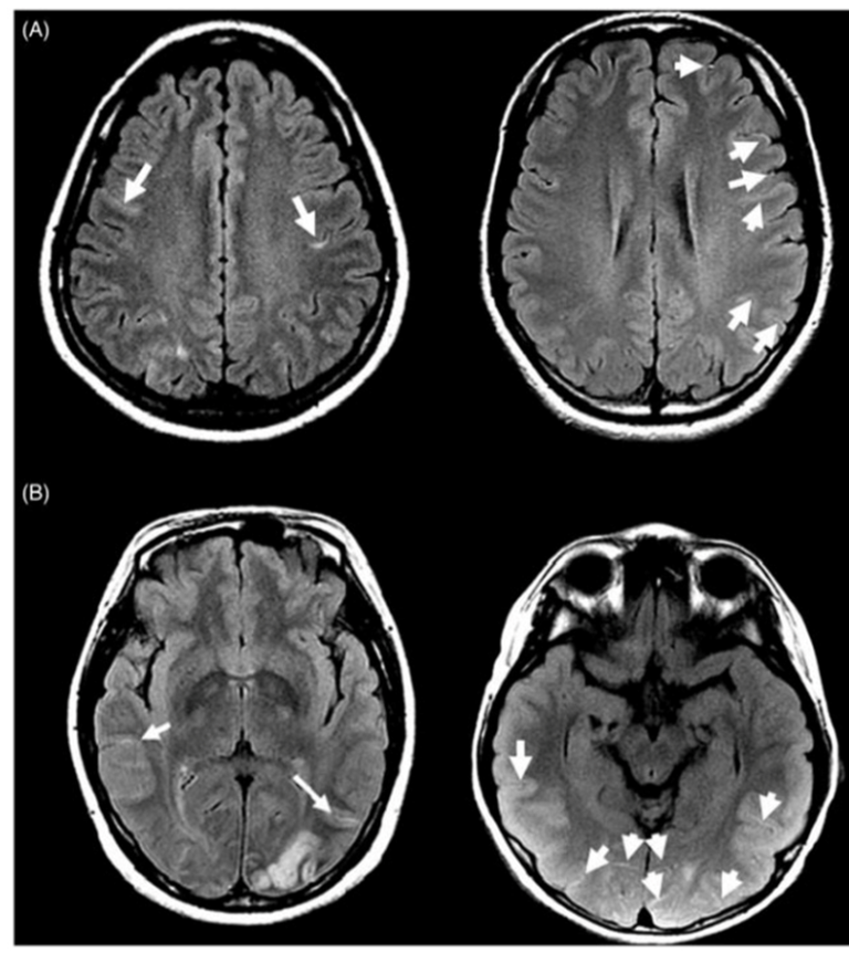 可逆性脳血管攣縮症候群（RCVS:Reversible Cerebral Vasoconstriction Syndrome） | ラジブロ ...
